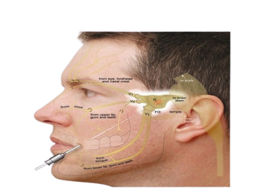 Neuralgia do trigêmeo
