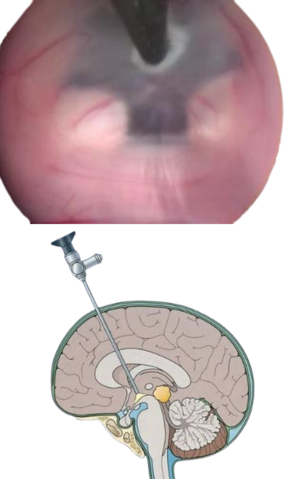 Endoscopia Cerebral